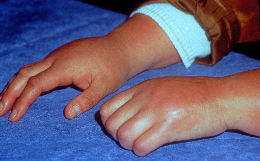 Posttraumatische Dystrofie Integraal Medisch Centrum