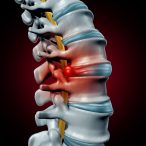 Hernia Nucleus Pulposi (Rughernia) - Osteopathie, Mesologie ...